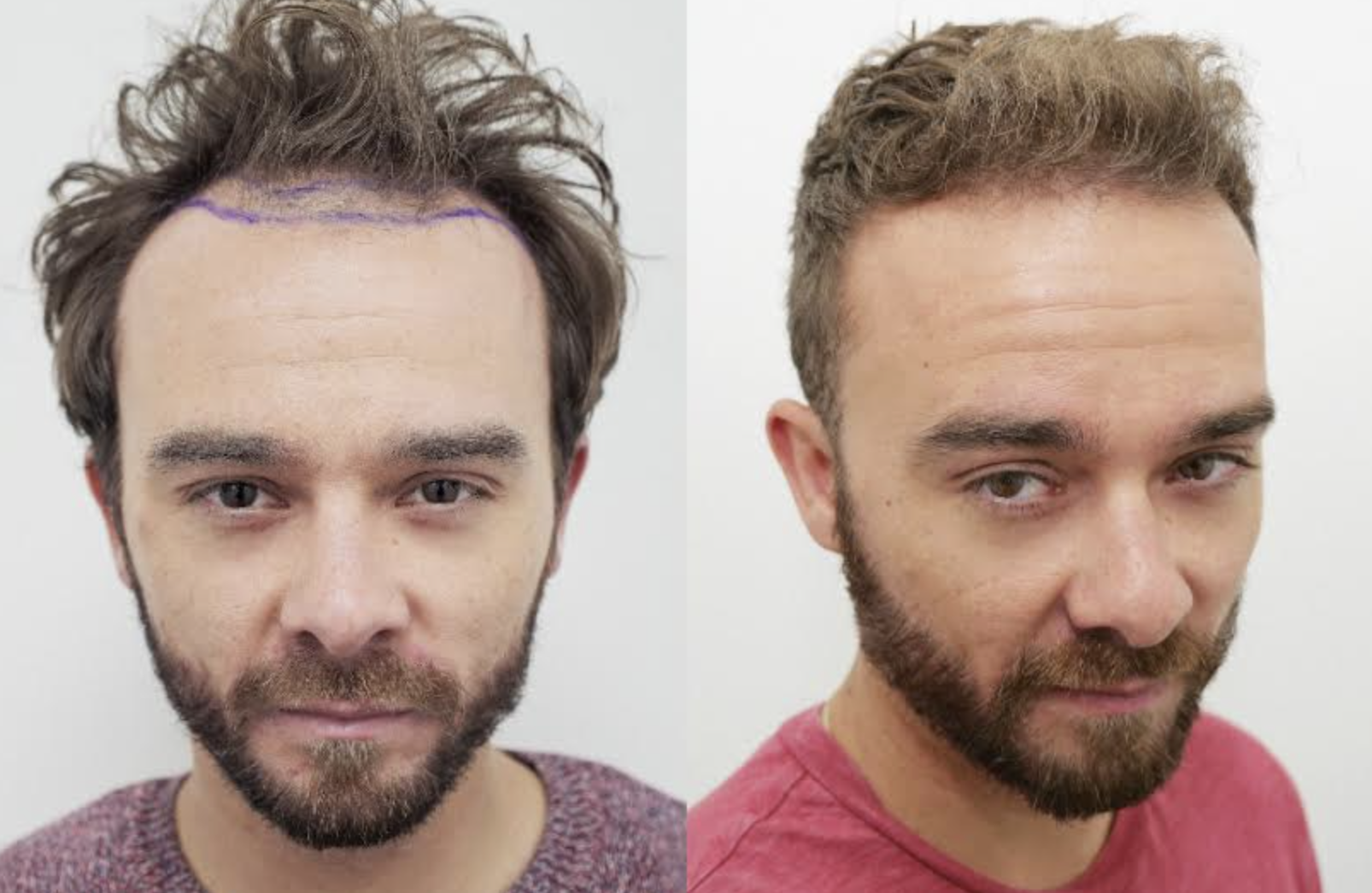 Can You Have More Than One Hair Transplant? | Crown Clinic