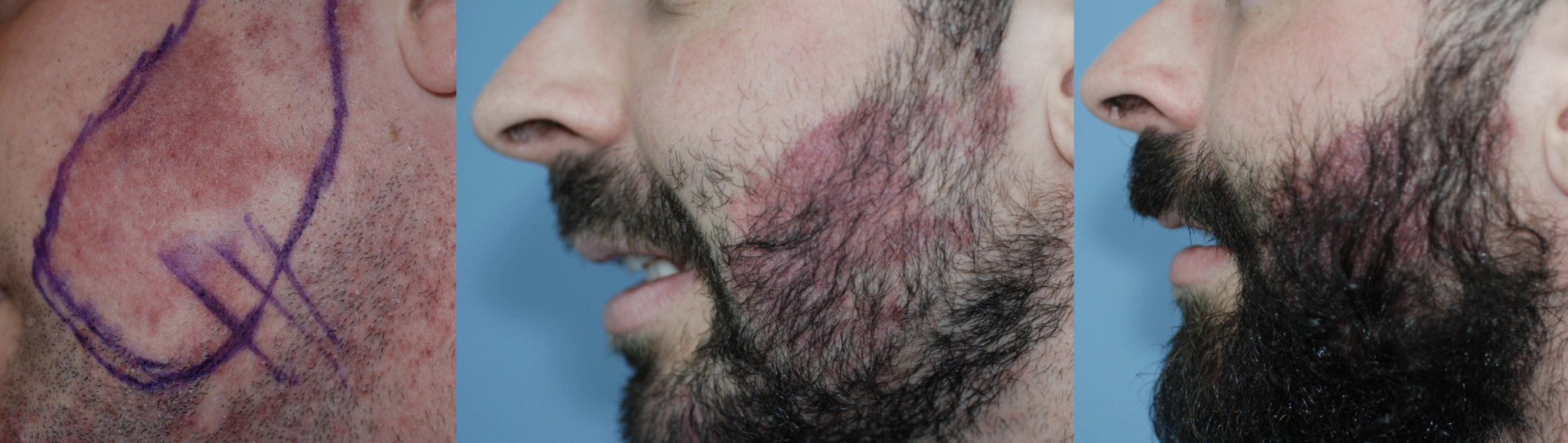 A Crown Clinic client has covered up the 'wine stain' birthmark on his ...